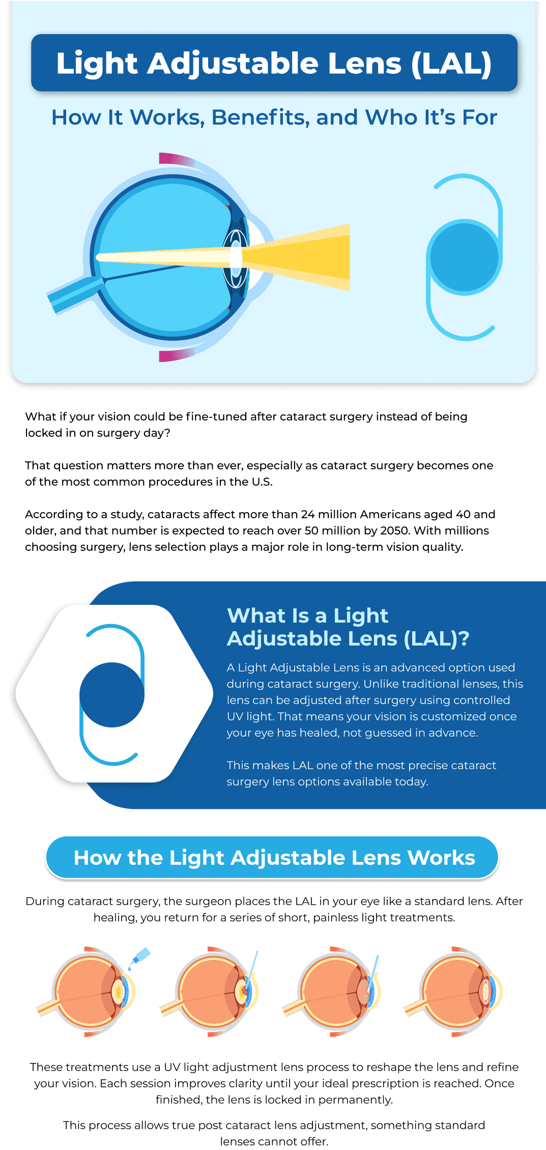 Light Adjustable Lens (LAL) | Advanced Cataract Surgery Option